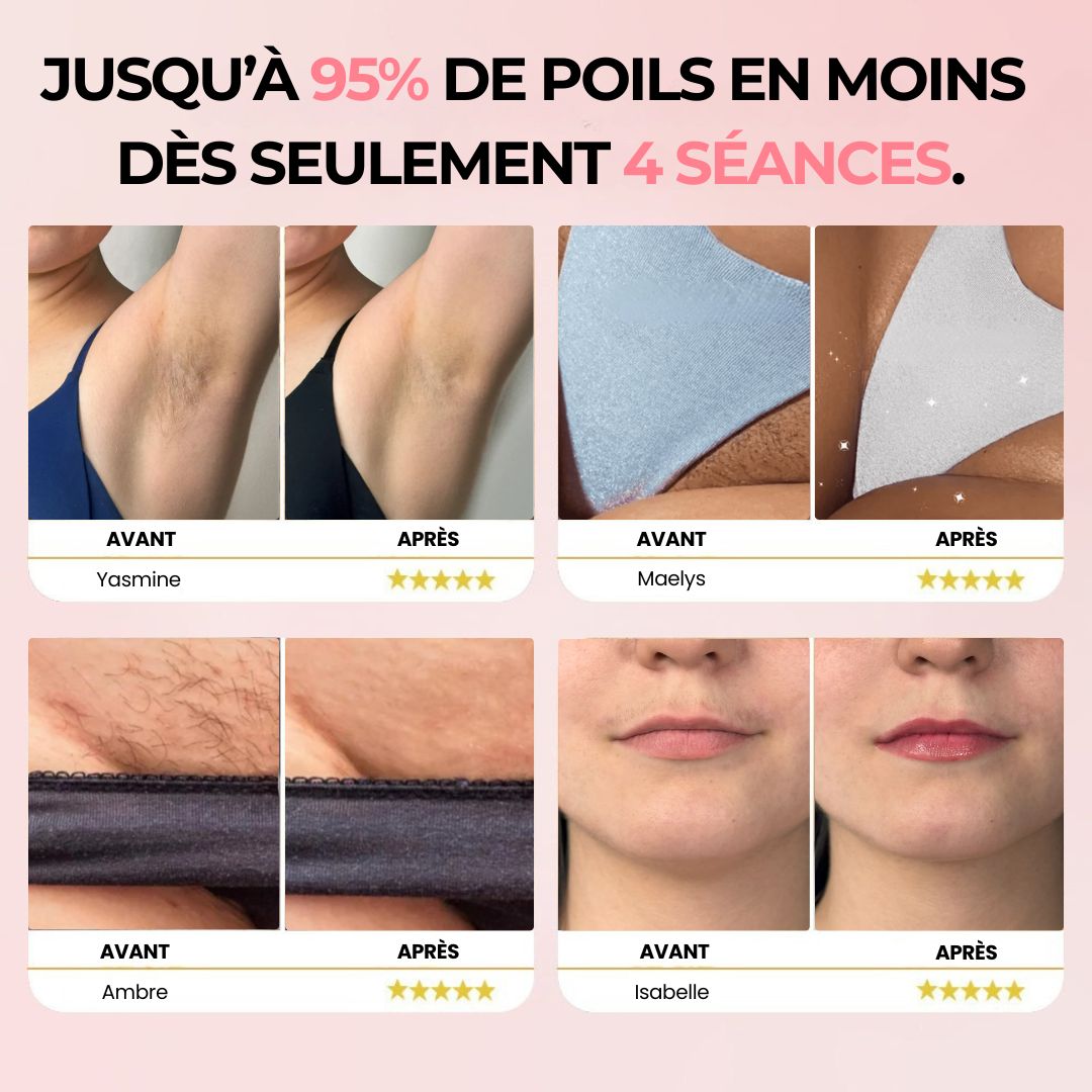 Epilateur Lumiere Pulse Avant Apres