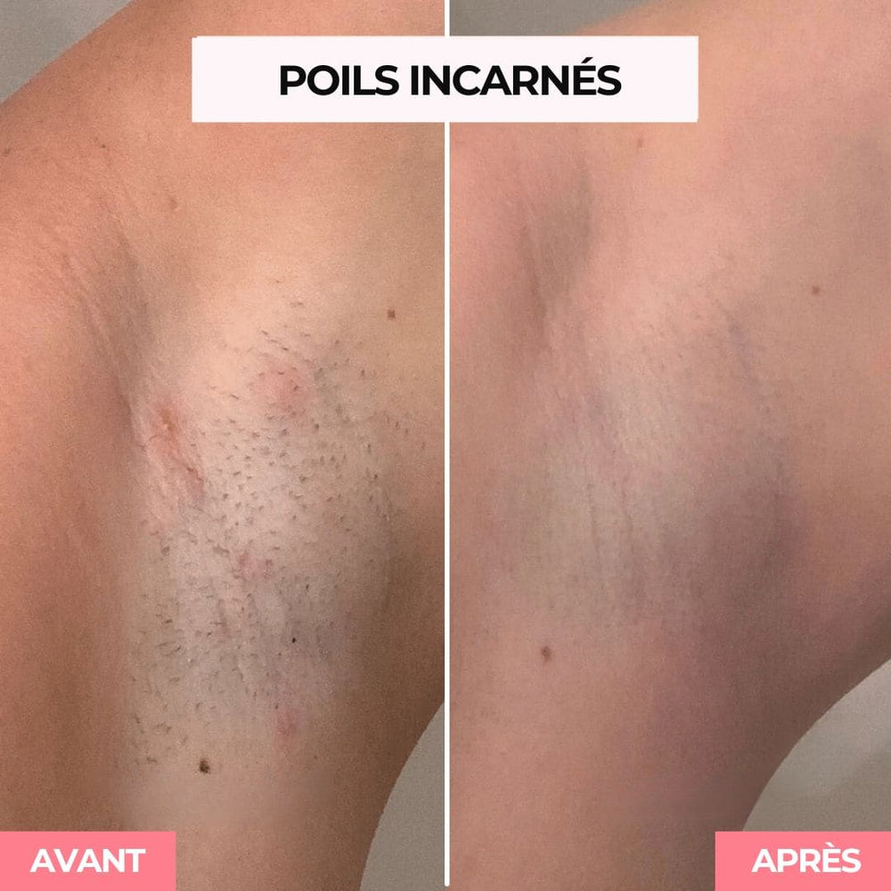 Epilateur Lumiere Pulse Avant Apres